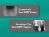 Placement of a Bicon SHORT® Implant and the Uncovering of Two Bicon ...