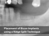 Placement of Three Bicon SHORT® Implants in a Ridge Split - Bicon ...
