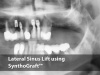 Lateral Sinus Lift using SynthoGraft™ - Bicon Dental Implants