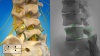 COOLIEF* Cooled Radiofrequency for Lumbar Z-Joint Pain | Avanos