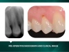 Placement of a Bicon SHORT® Implant using an Immediate Stabilization ...