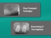 Placement of a Bicon SHORT® Implant using a Floor Transport Technique ...