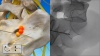 COOLIEF* Cooled Radiofrequency for Sacroiliac Joint Syndrome | Avanos